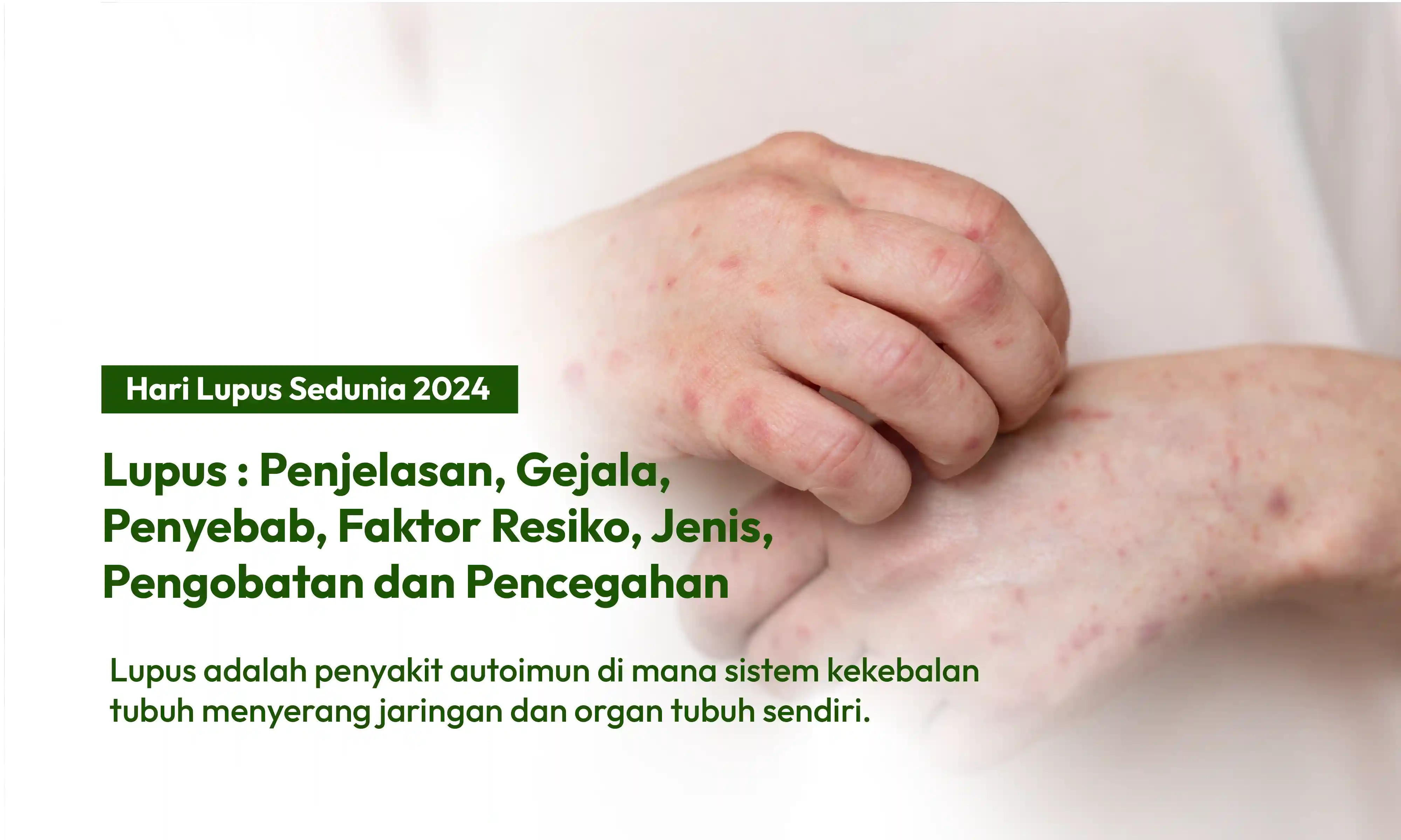 Charitas Group | Lupus : Penjelasan, Gejala, Penyebab, Faktor Resiko ...