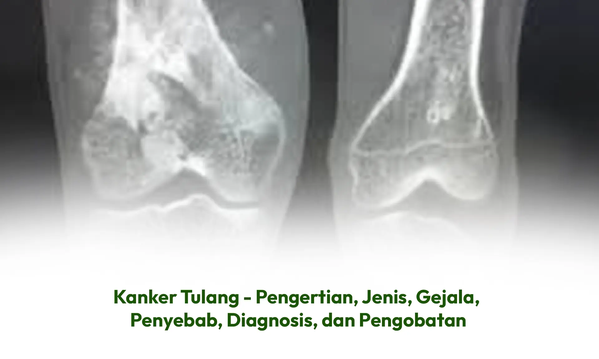 Charitas Group | Kanker Tulang - Pengertian, Jenis, Gejala, Penyebab ...